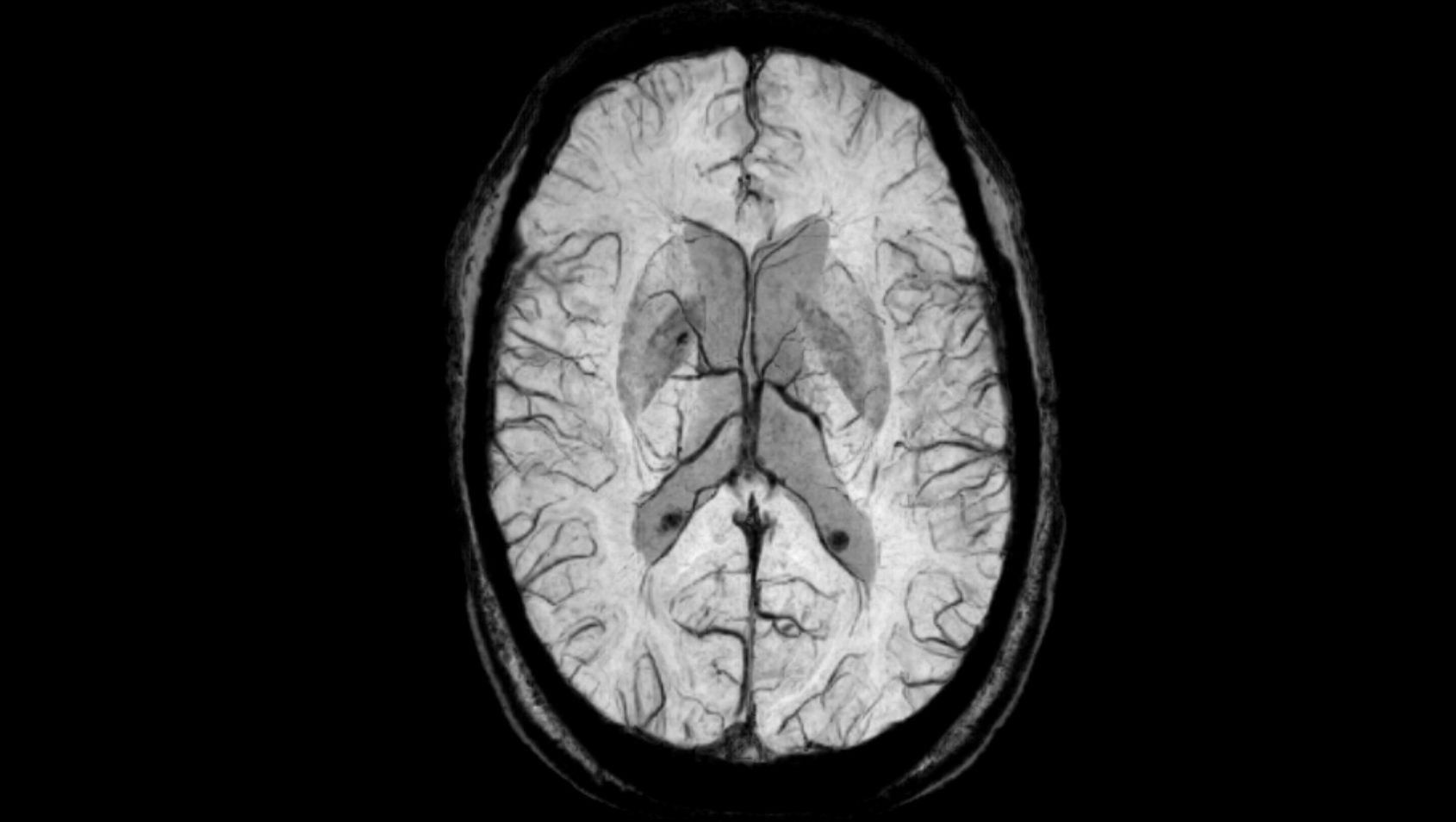 Neurology MRI - Siemens Healthineers