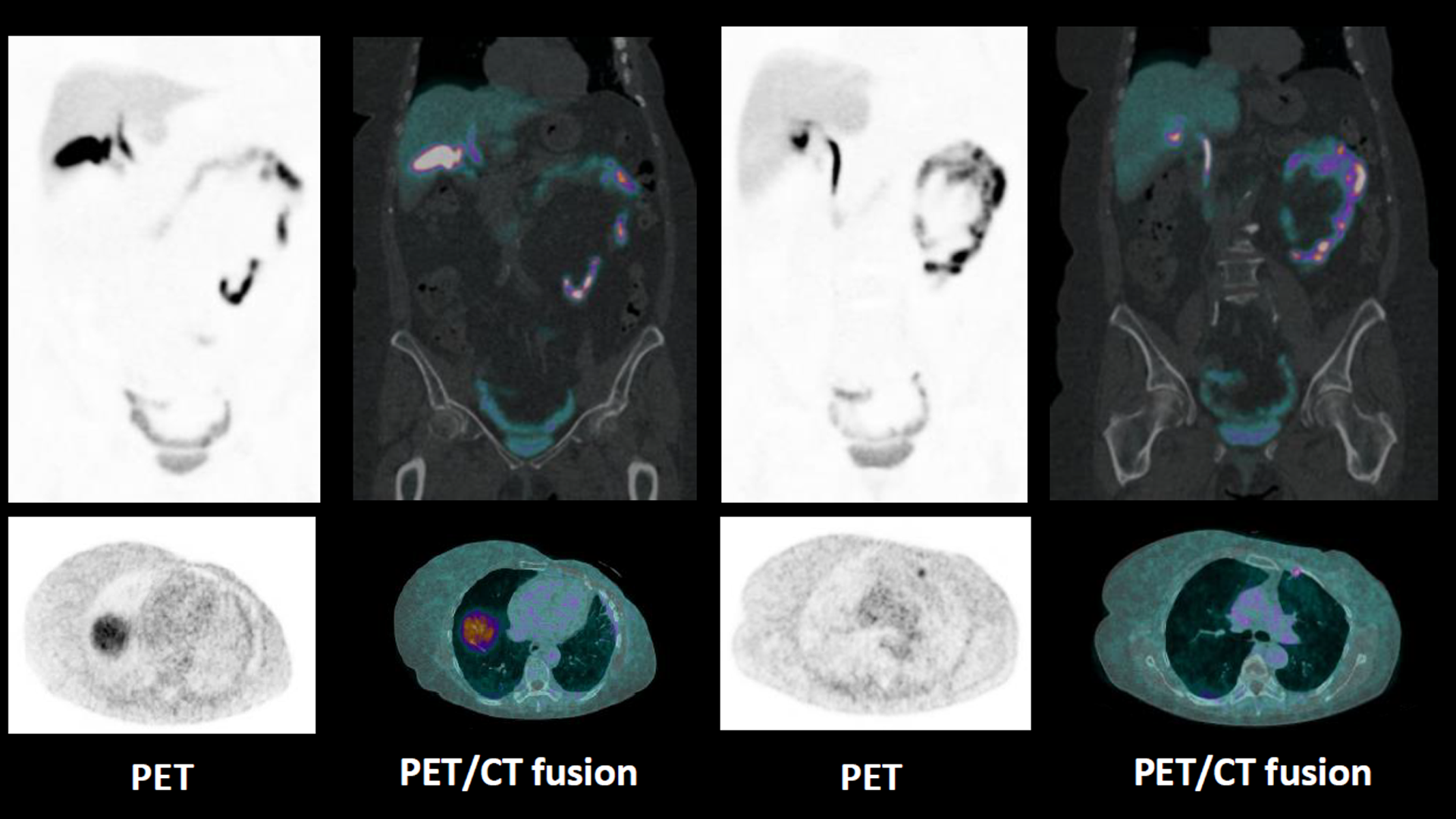 Biograph Vision PET/CT Scanner - Siemens Healthineers India