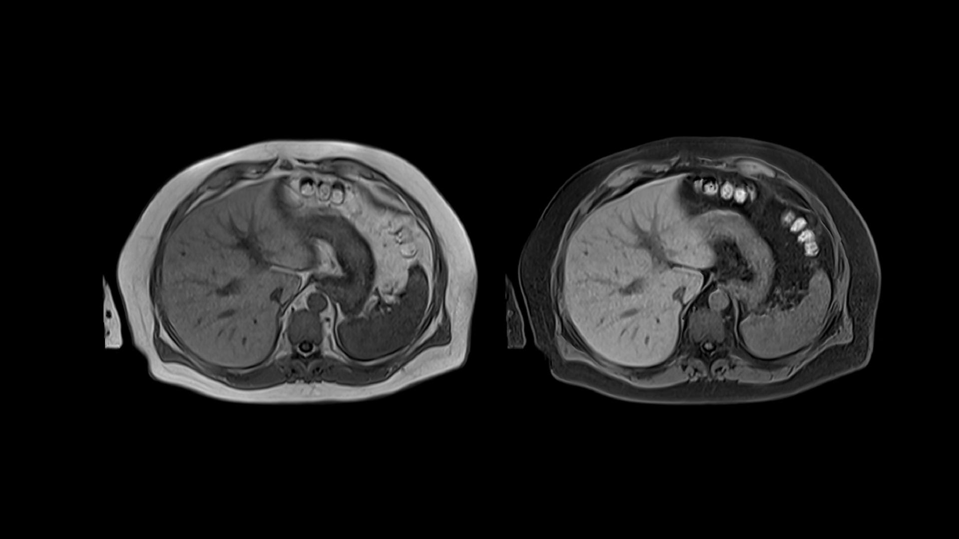 MAGNETOM Free.Max – Open Bore MRI - Siemens Healthineers USA