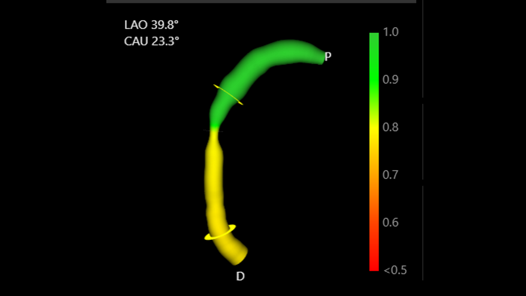 vFFR - angio-derived FFR measurements - Siemens Healthineers - Siemens ...