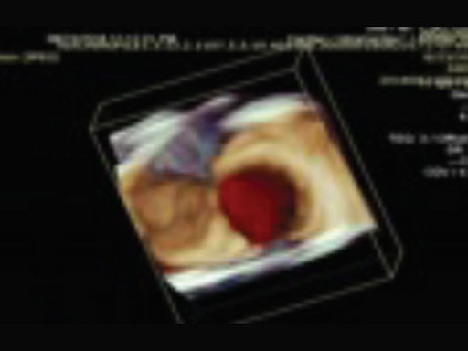 Intracardiac Echocardiography with AcuNav Ultrasound Catheters ...