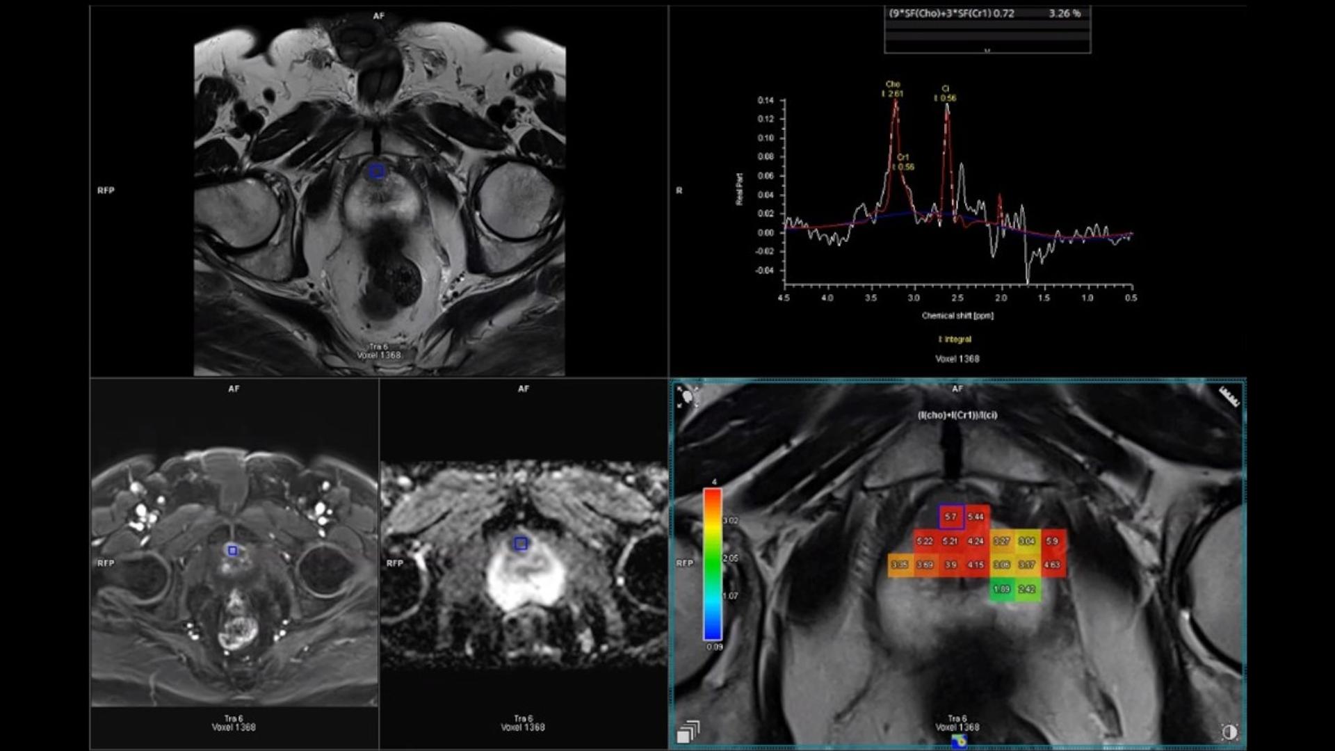 MAGNETOM Prisma - MRI Scanner - Siemens Healthineers