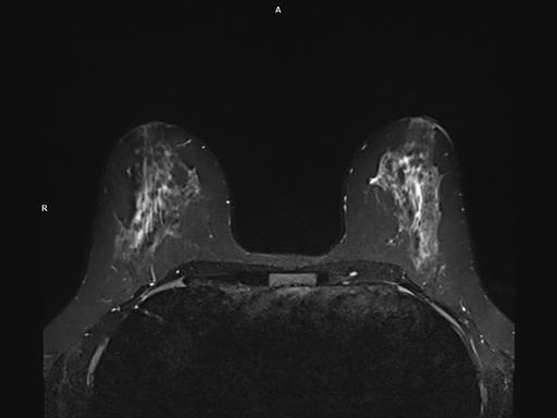 NeoCoil - Siemens Healthineers USA