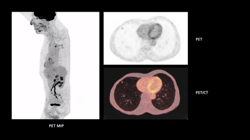 Biograph Vision PET/CT Clinical Image Gallery - Siemens Healthineers