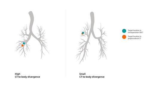 Image-guided robotic bronchoscopy - Siemens Healthineers USA