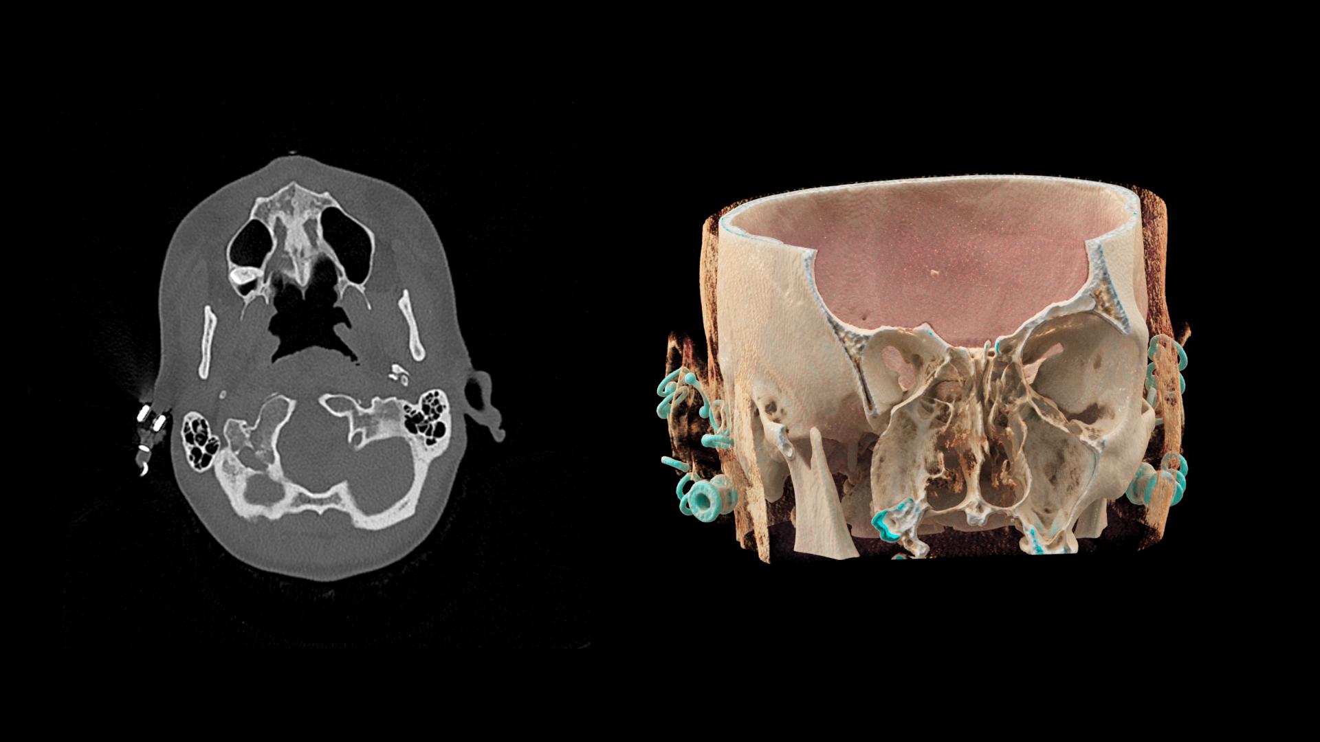 SOMATOM Edge Plus - Siemens Healthineers USA