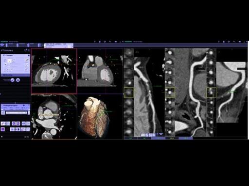 syngo.CT Coronary Analysis - Siemens Healthineers