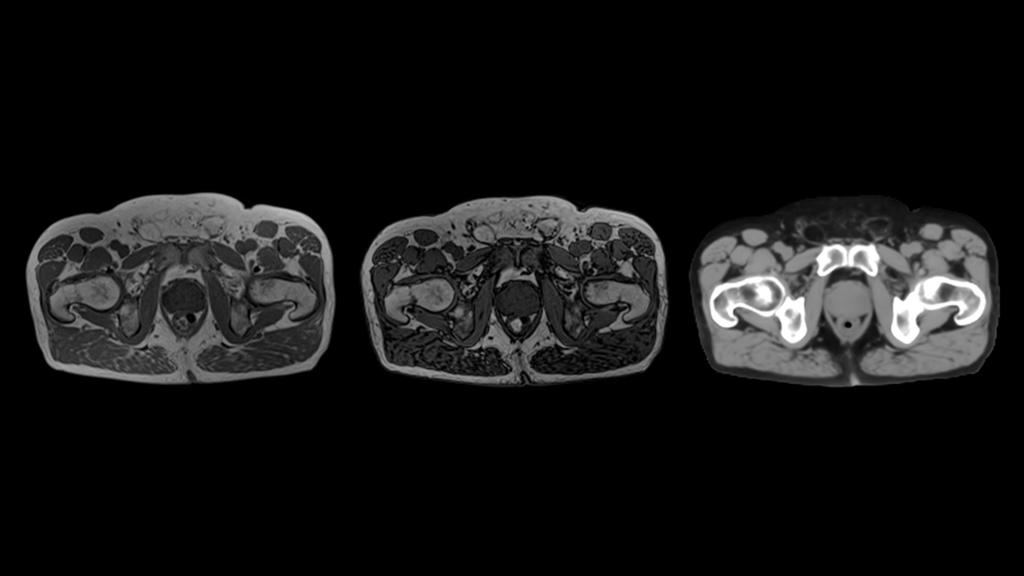 MR-only Radiotherapy Planning - Siemens Healthineers