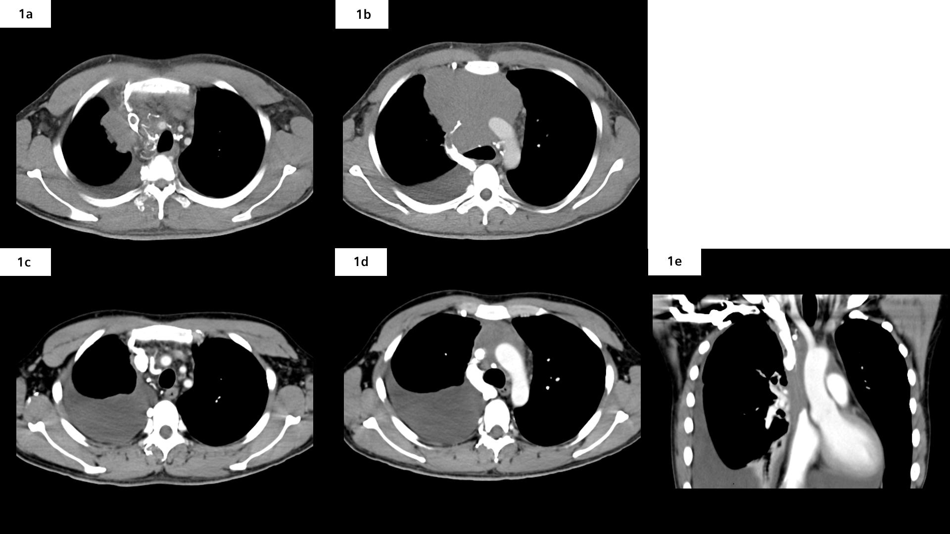 Superior vena cava obstruction caused by a primary mediastinal large B ...