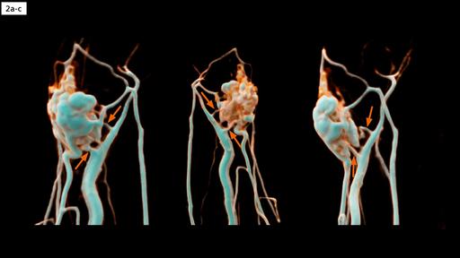 Subcutaneous arteriovenous malformation on the right wrist - Siemens ...