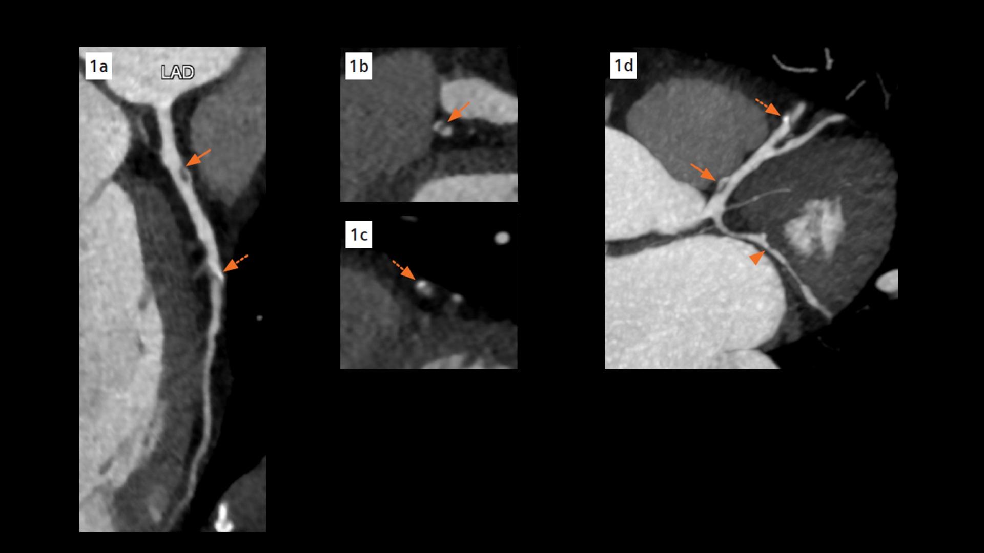 Multiple Coronary Stenoses Secondary to Atherosclerosis in an ...