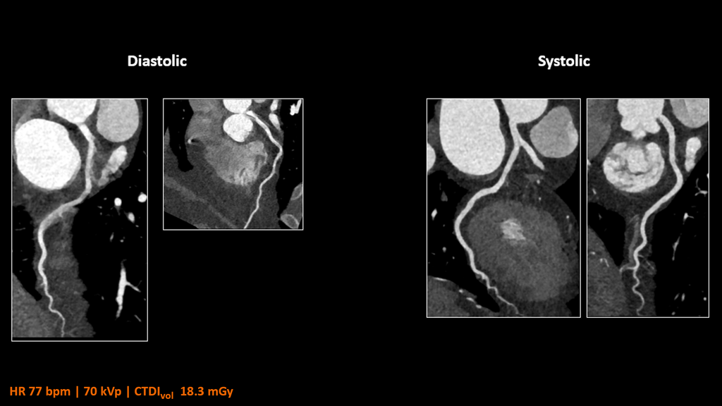 Dual Source CT - Siemens Healthineers