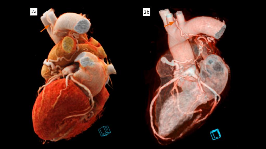 Complex Coronary Artery Fistulas & Aneurysm in an Asymptomatic Patient ...