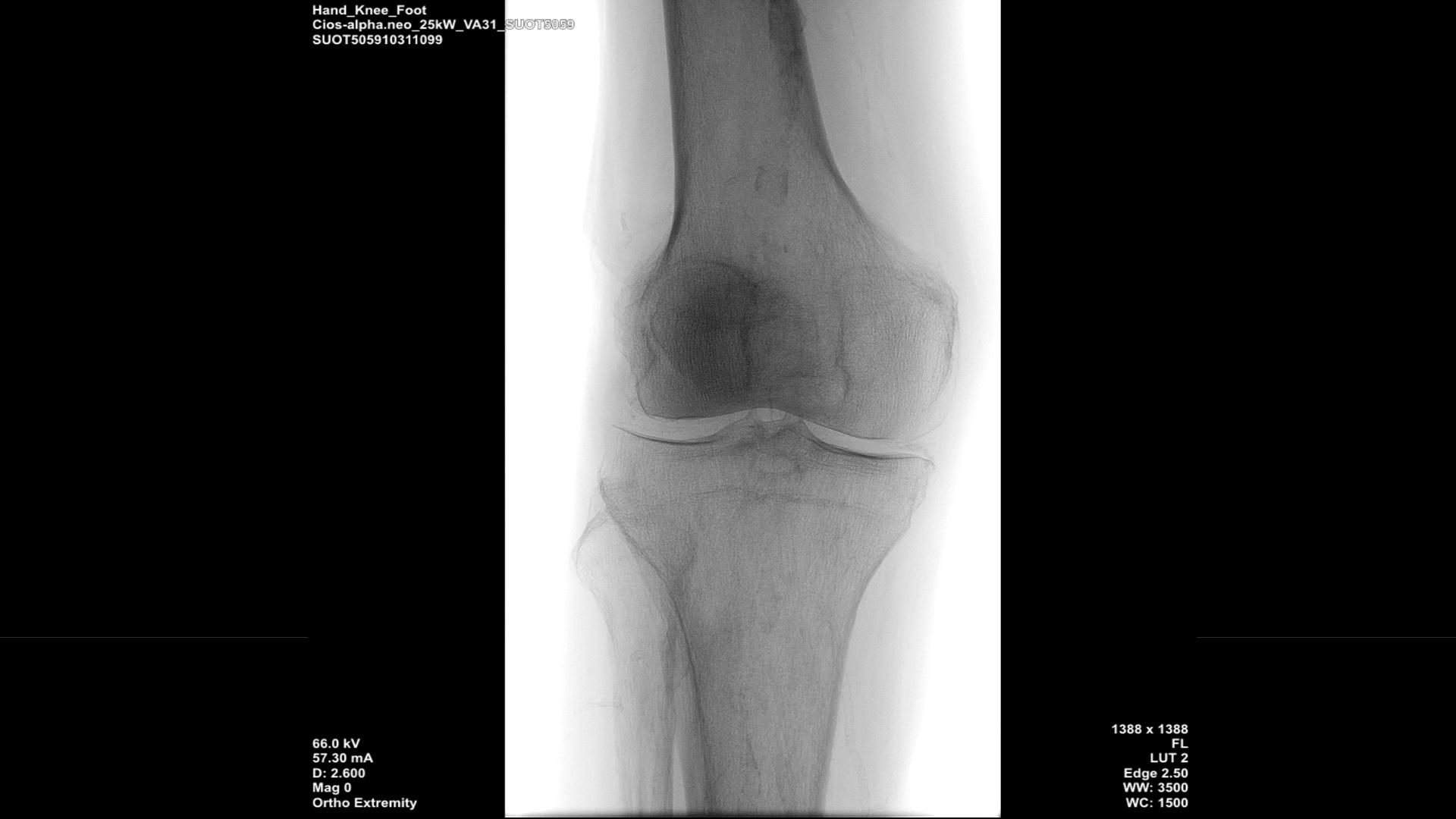 Cios Alpha.neo – Mobile C-arm machine