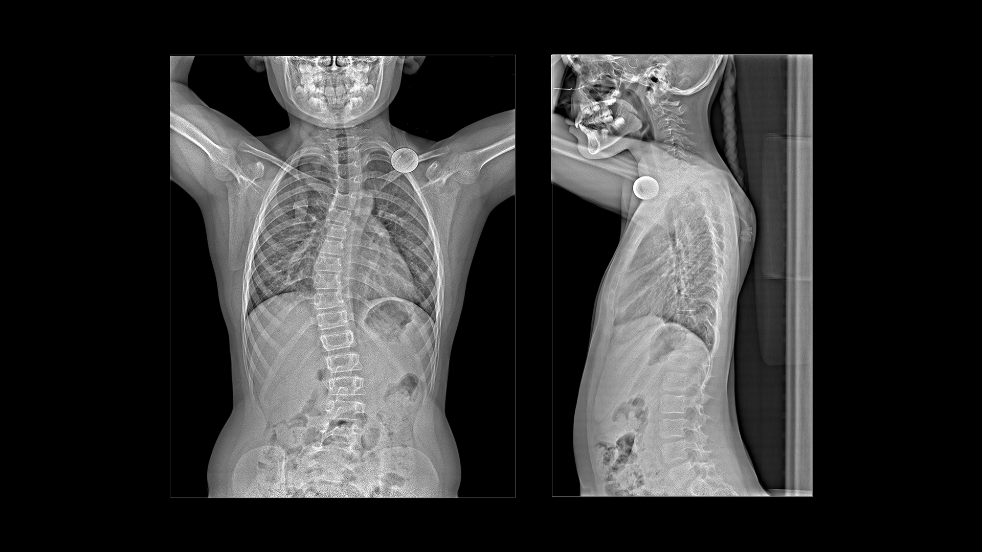 Twin Robotic X-ray scanner – Multitom Rax - Siemens Healthineers