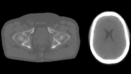 MRI for radiation therapy - Siemens Healthineers