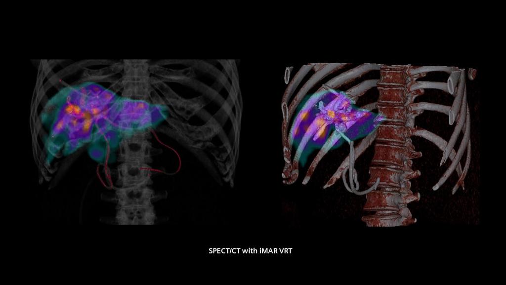 Symbia Pro.specta SPECT/CT - Siemens Healthineers