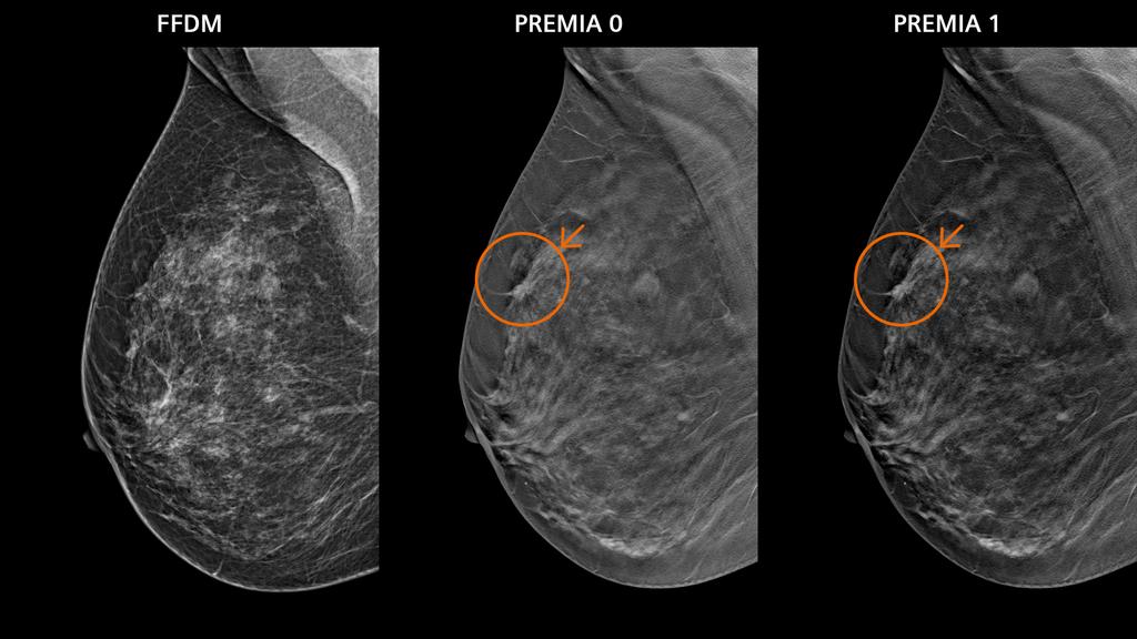 MAMMOMAT B.brilliant - Siemens Healthineers India