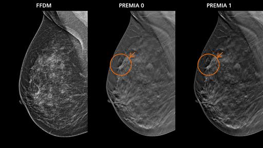 MAMMOMAT B.brilliant - Siemens Healthineers