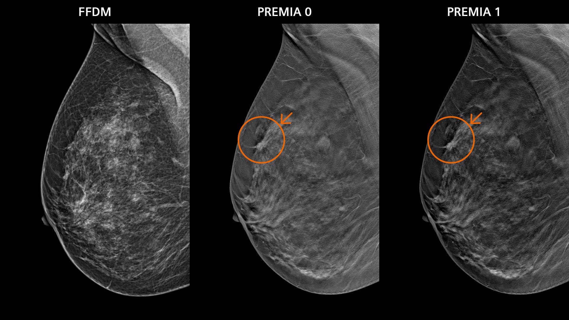 MAMMOMAT B.brilliant - Siemens Healthineers