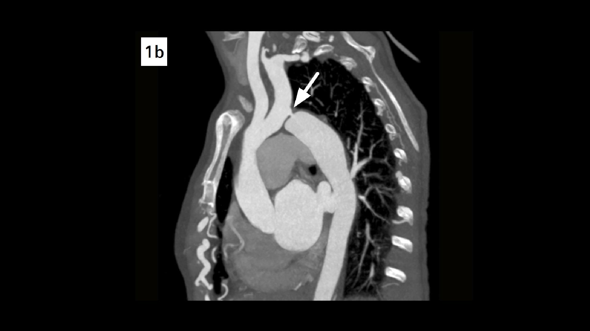 Severe aortic coarctation in an adult - Siemens Healthineers
