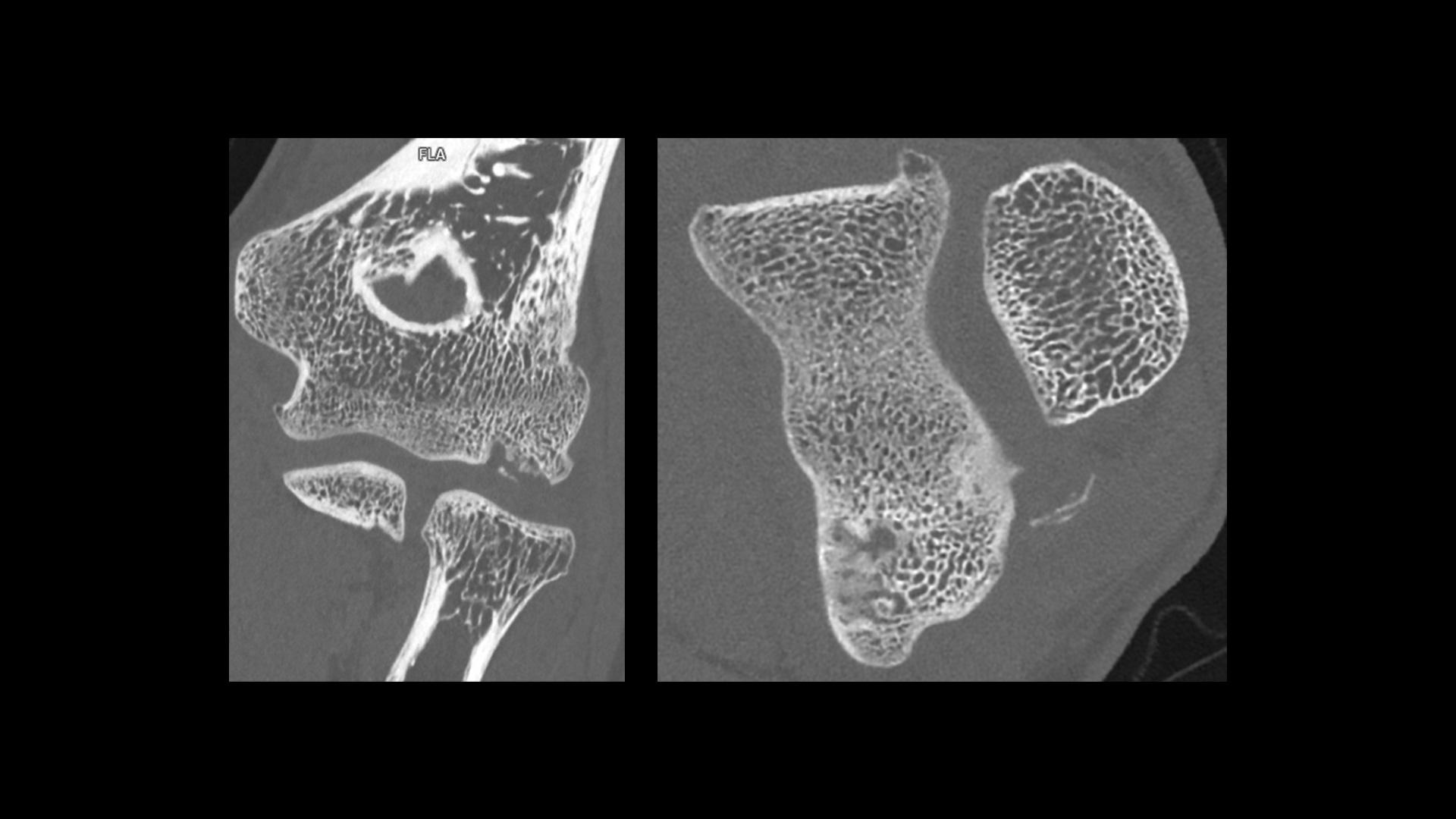 Photon-counting CT musculoskeletal imaging - Siemens Healthineers