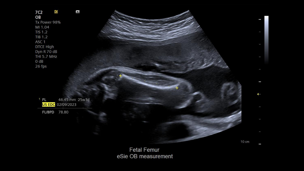 ACUSON Maple is a High-Performance Shared Service Ultrasound System ...