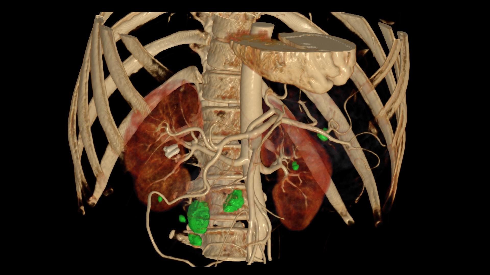 Multiple gastrinomas - Siemens Healthineers USA