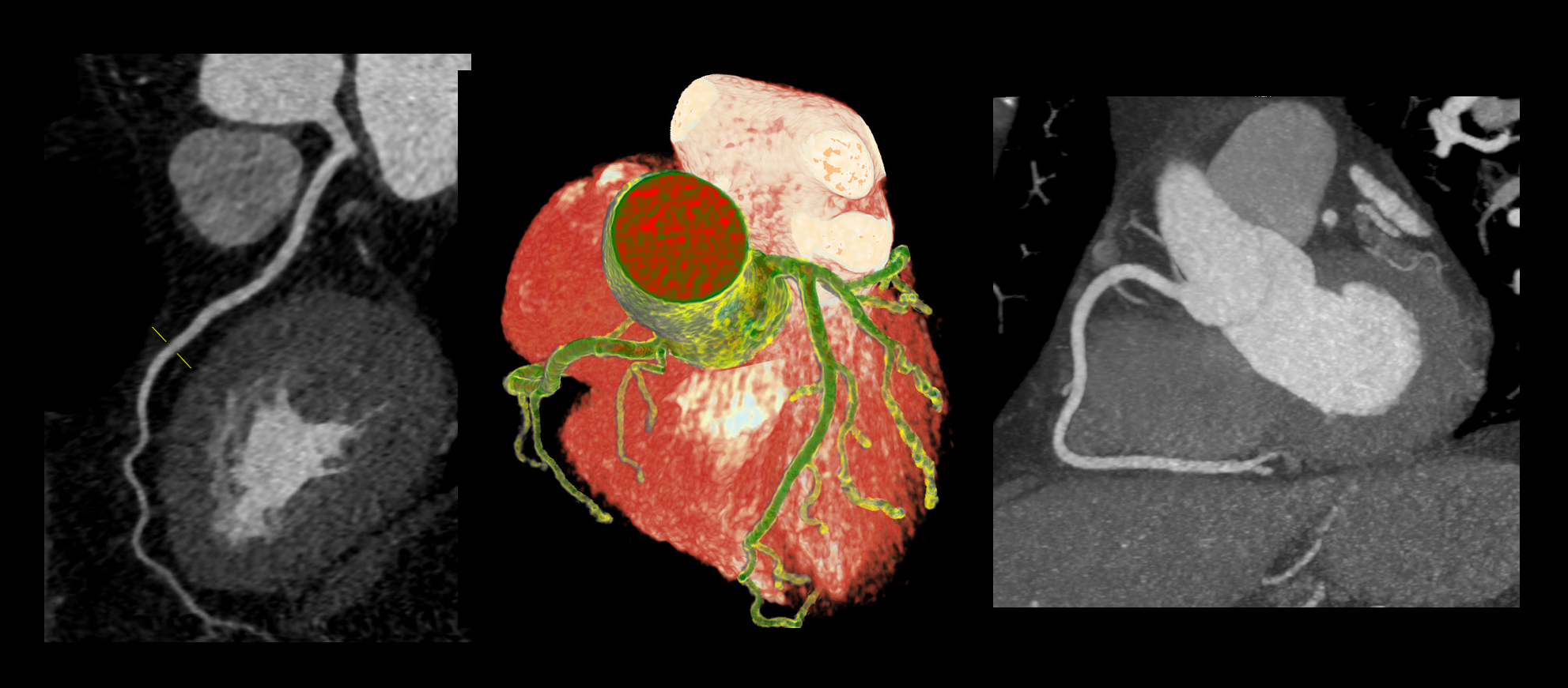 Cardiac CT Imaging of Irregular Heart Rhythms – Case Discussion with ...