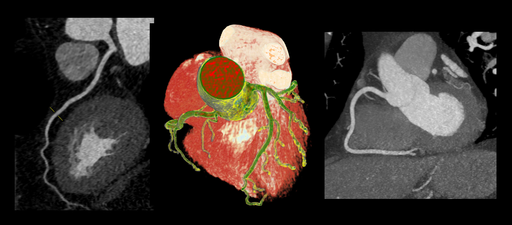 Cardiac CT Imaging of Irregular Heart Rhythms – Case Discussion with ...