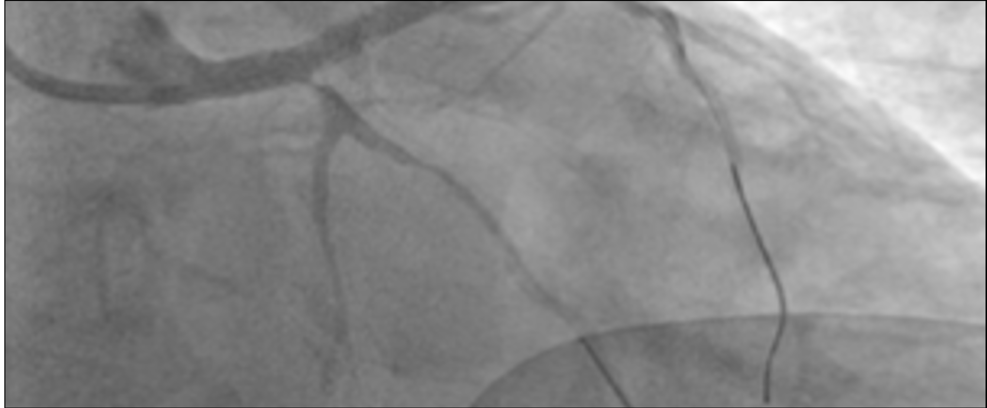 Enhanced stent visualization assists in improving the outcome of ...