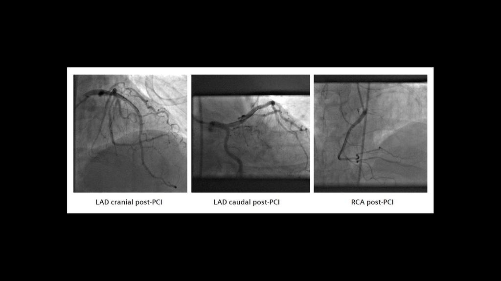 PET/CT delineation of multivessel coronary artery disease and post ...