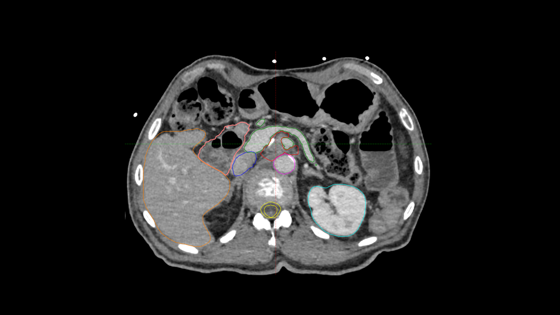 NAEOTOM Alpha.Prime RT Pro Edition - Siemens Healthineers