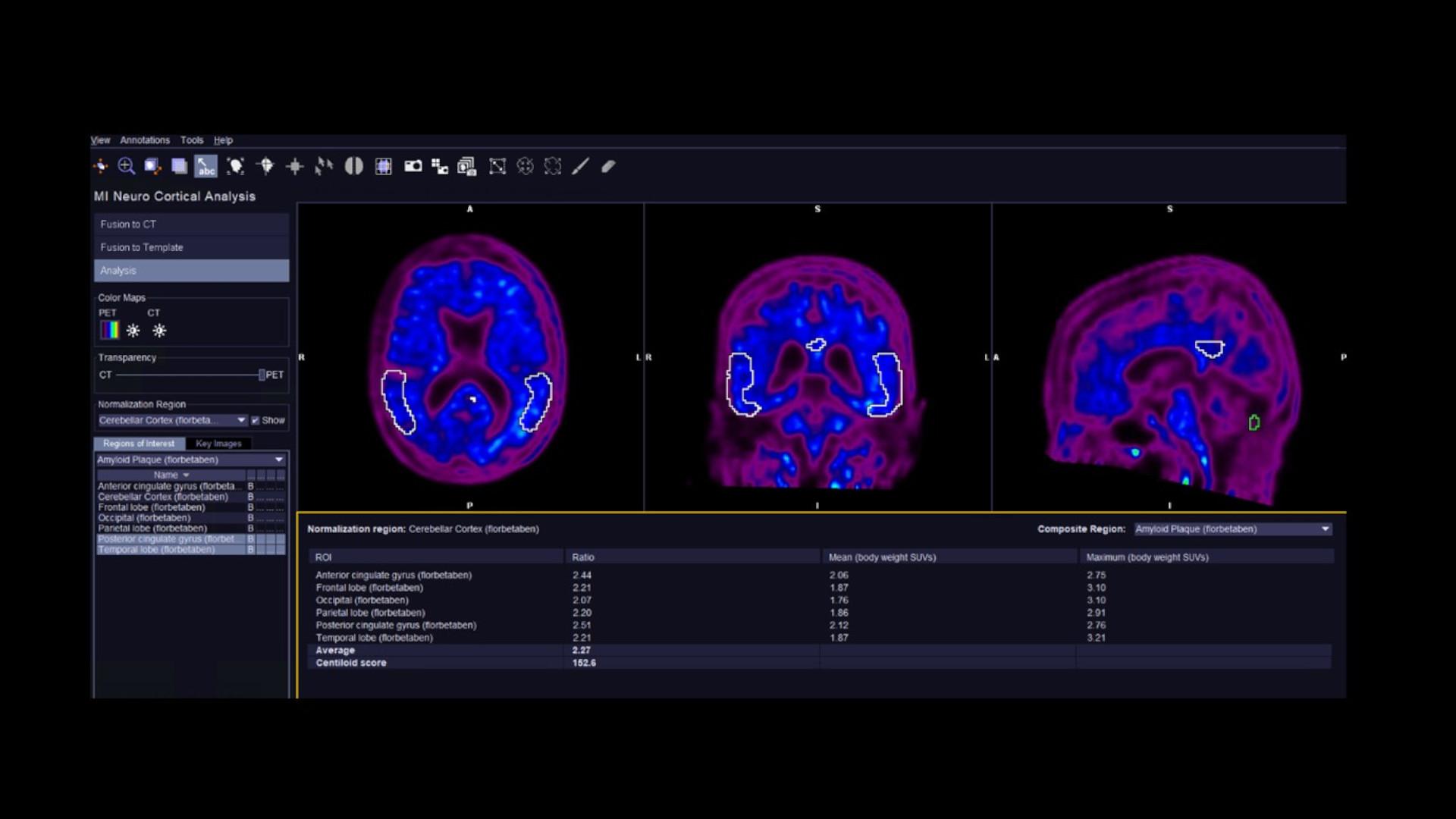 Beta-amyloid PET/CT imaging in the assessment for anti-amyloid ...