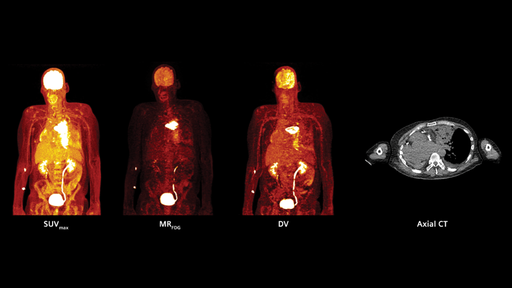 Biograph Vision PET/CT Clinical Image Gallery - Siemens Healthineers