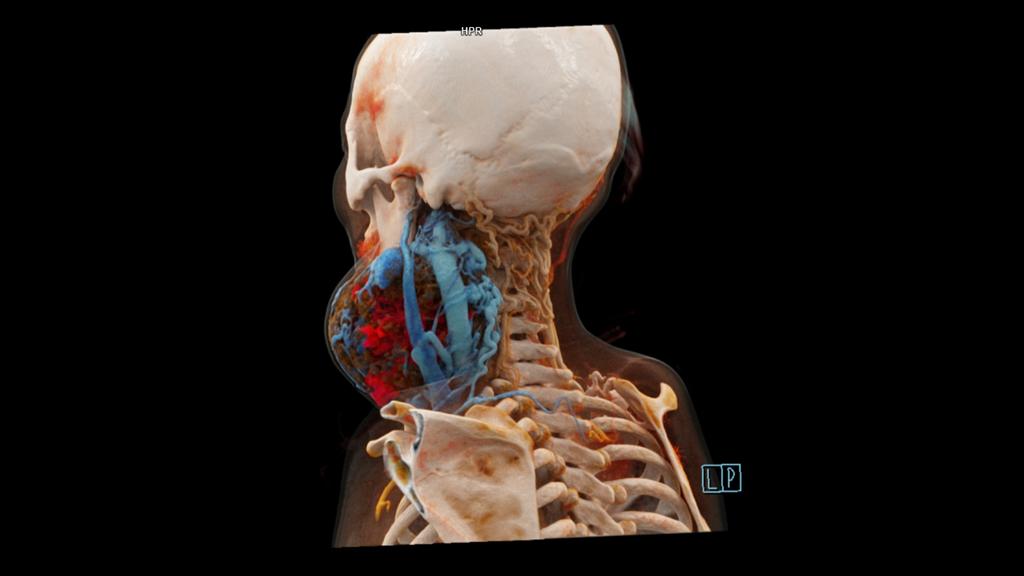 Massive carotid body tumor - Siemens Healthineers India