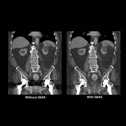 SOMATOM Definition Edge - Siemens Healthineers Polska