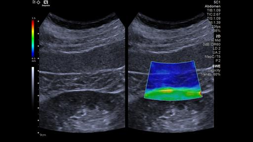 ACUSON Sequoia Ultrasound Machine for Pediatrics - Siemens Healthineers