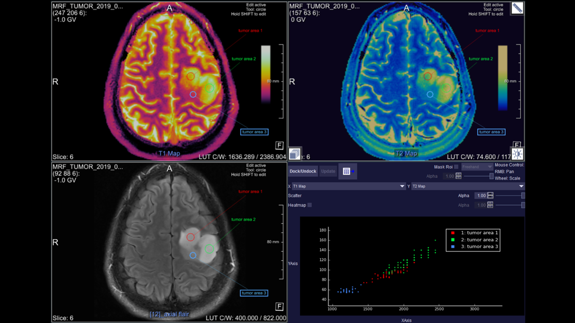 MR Fingerprinting - Siemens Healthineers