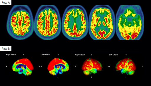 Decoding Brain Metabolism: Insights from 18F-FDG PET/CT Studies using ...