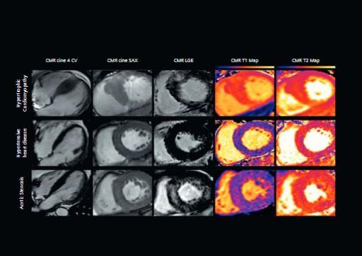 Mapping cardiaco MRI Siemens Healthineers Italia