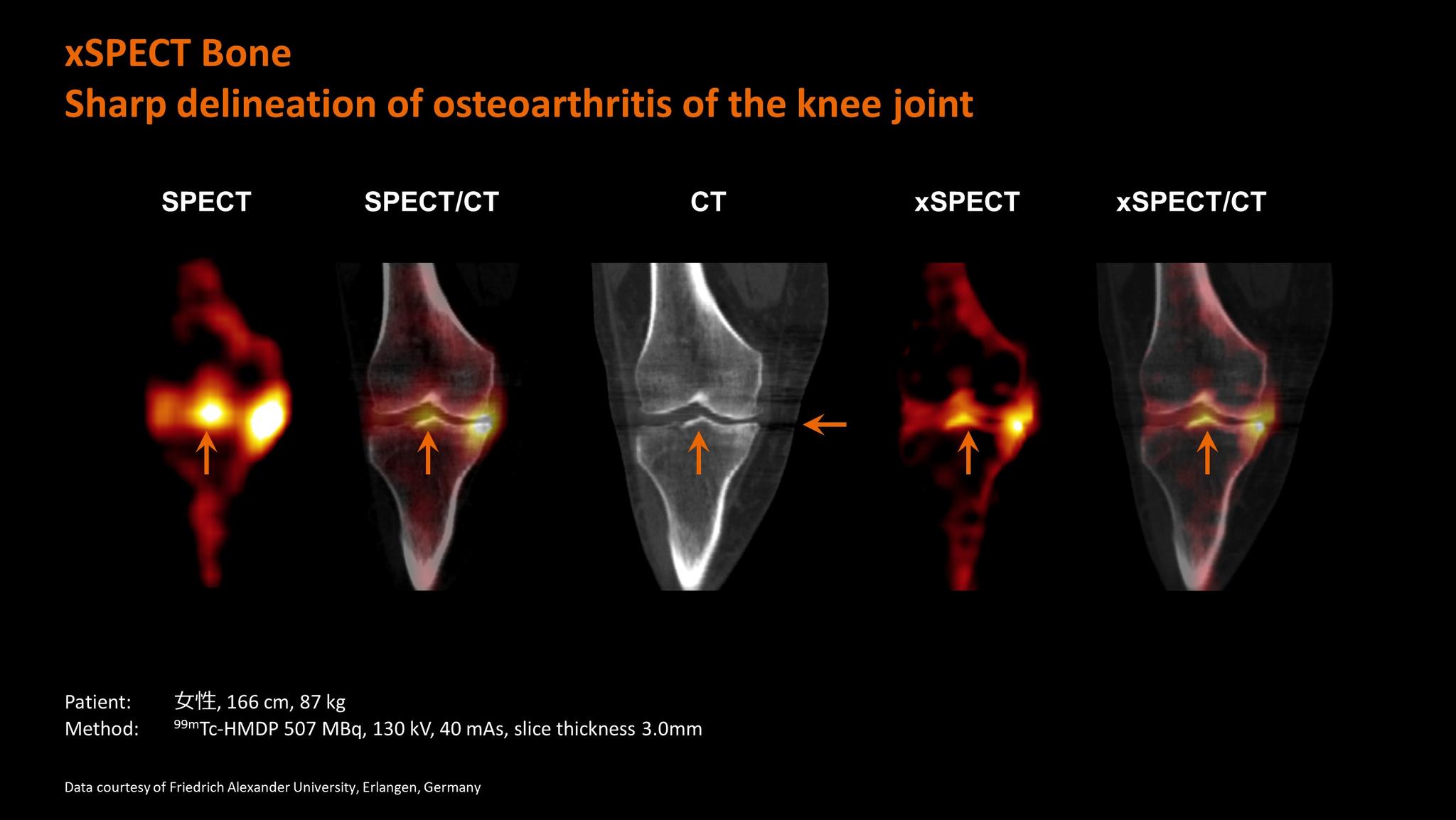 xSPECT Bone - Siemens Healthineers Japan