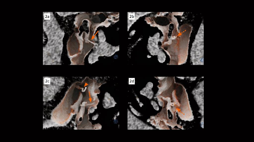 Stapes prosthesis dislocation Siemens Healthineers Nederland