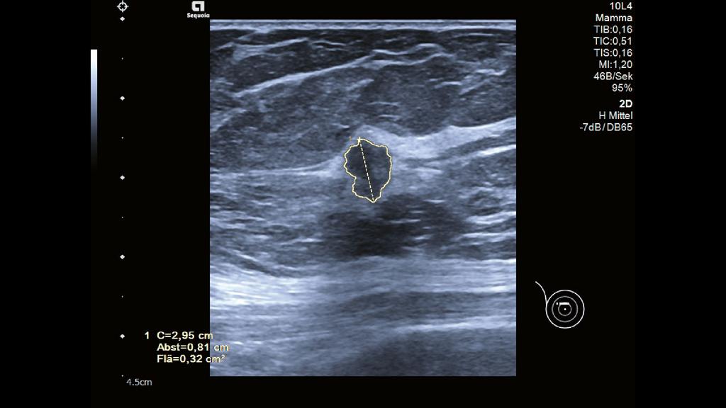 Casos prácticos de ultrasonido de mama - Siemens Healthineers Latinoamérica
