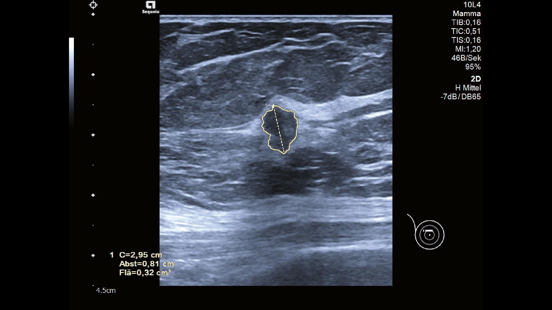 Casos prácticos de ultrasonido de mama - Siemens Healthineers Latinoamérica