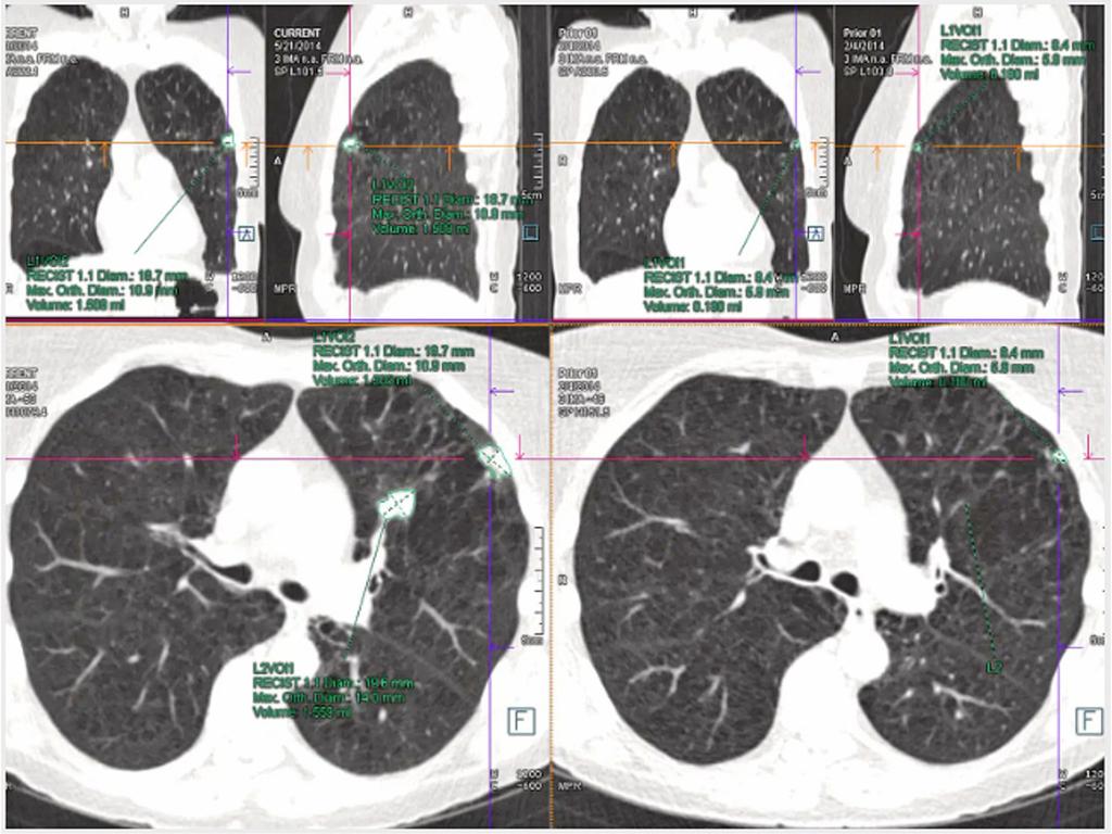 Diagnosis And Treatment Of Lung Cancer - Siemens Healthineers
