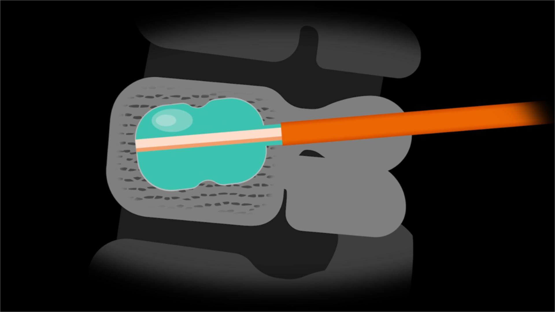 Interventional Oncology Procedures - Siemens Healthineers