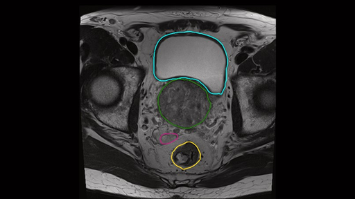 AI-Rad Companion - Siemens Healthineers USA