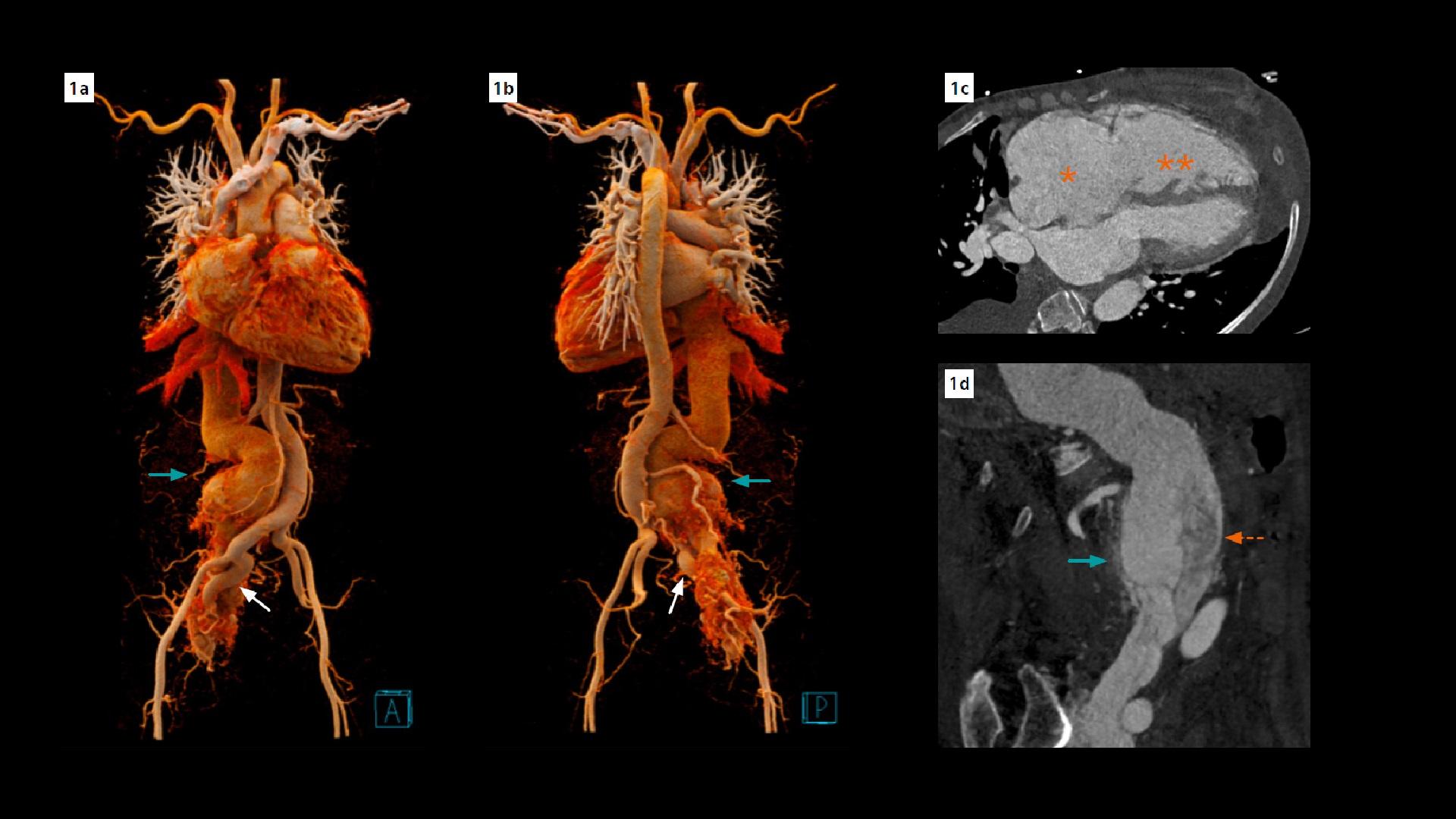 Right internal iliac arteriovenous fistula complicated by right heart ...
