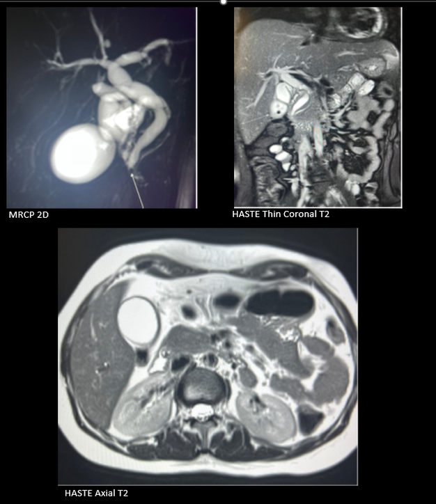 MRI Cholangio Pancreatography